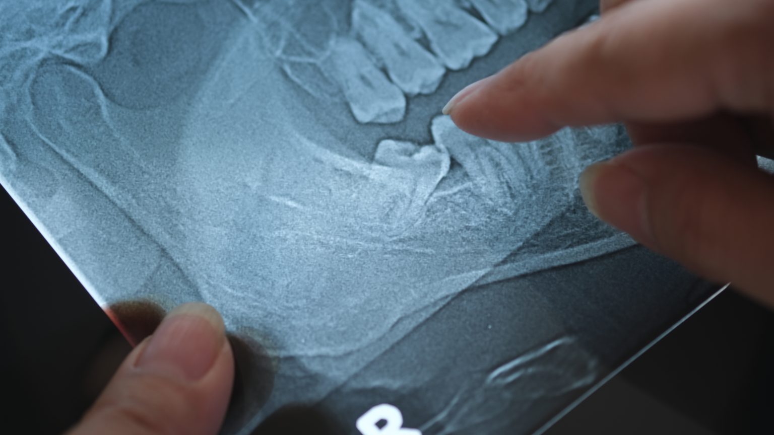 Essential Guide to Wisdom Teeth Removal for Patients